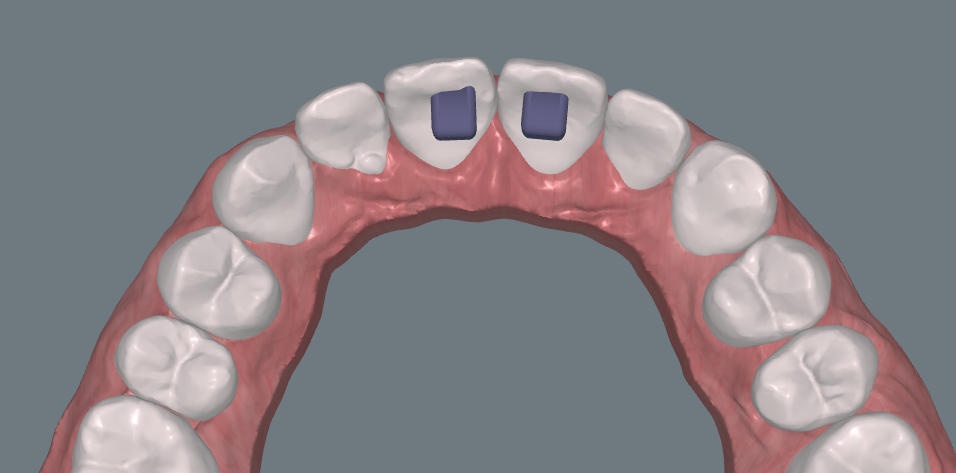Bite Ramps Overview – ProMonitoring