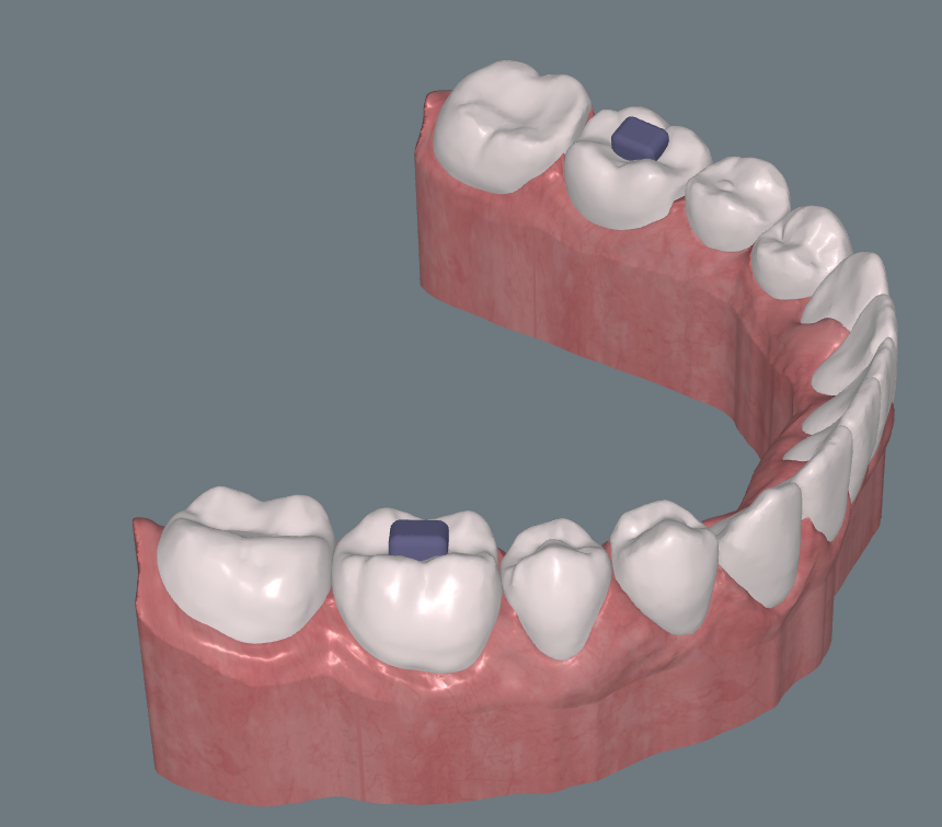 Bite Ramps Overview – ProMonitoring