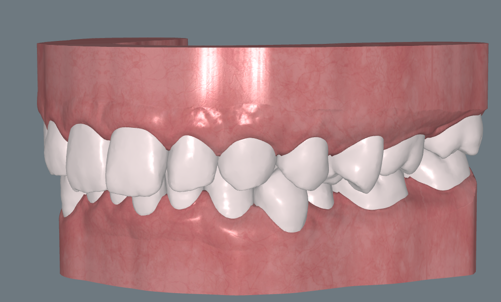 Anterior Bite Ramps – ProMonitoring