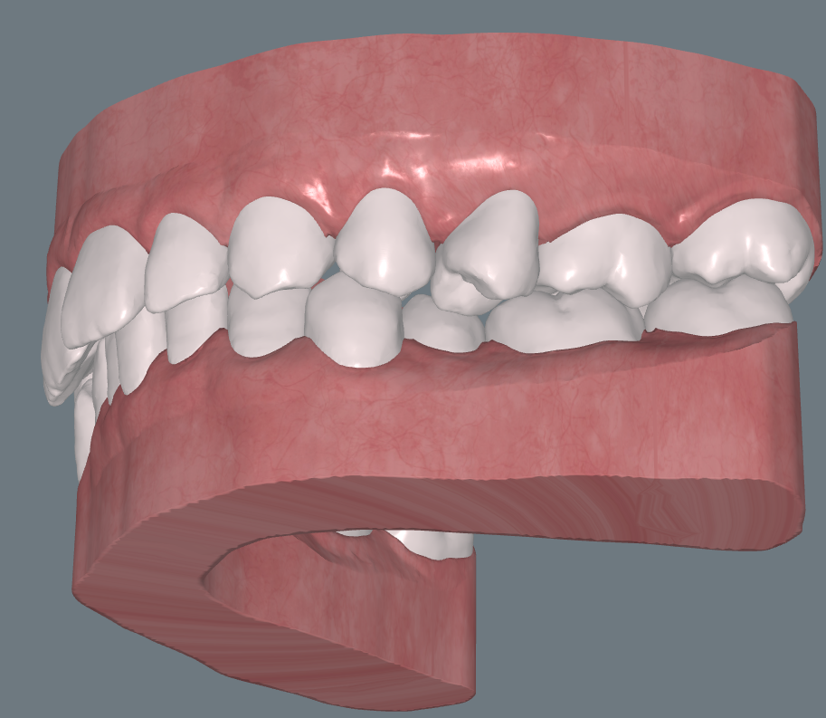 Posterior Bite Ramps – ProMonitoring